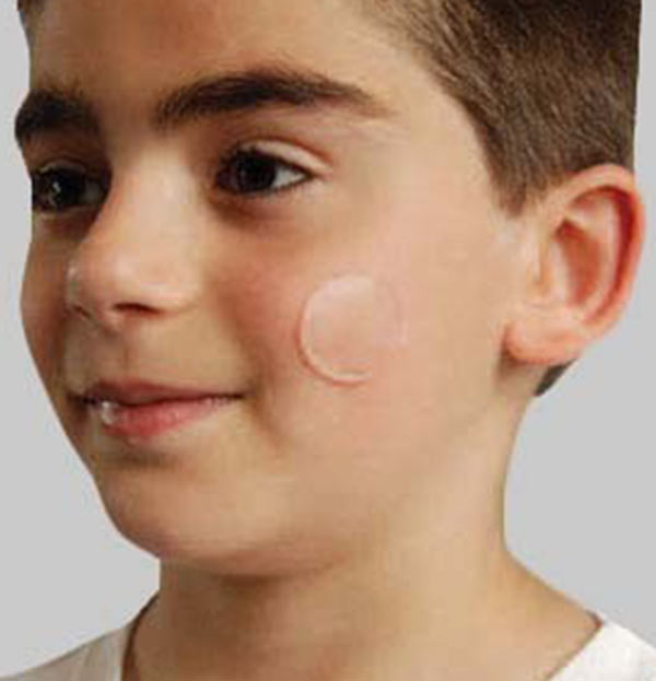 Silicone Gel Dots for Scars - Clear (NG-380) - Scarless Canada